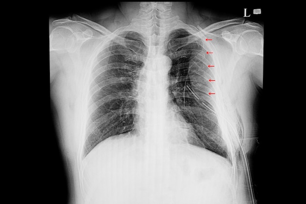 Filme de radiografia de tórax de um paciente com múltiplas fraturas de ... Filme de radiografia de tórax de um paciente com múltiplas fraturas de ...