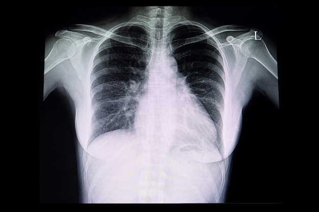 Uma radiografia de tórax de um paciente com cardiomegalia | Foto Premium Uma radiografia de tórax de um paciente com cardiomegalia | Foto Premium