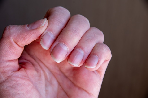 Premium Photo Close Up Of Female Nails After A Bad Manicure On A