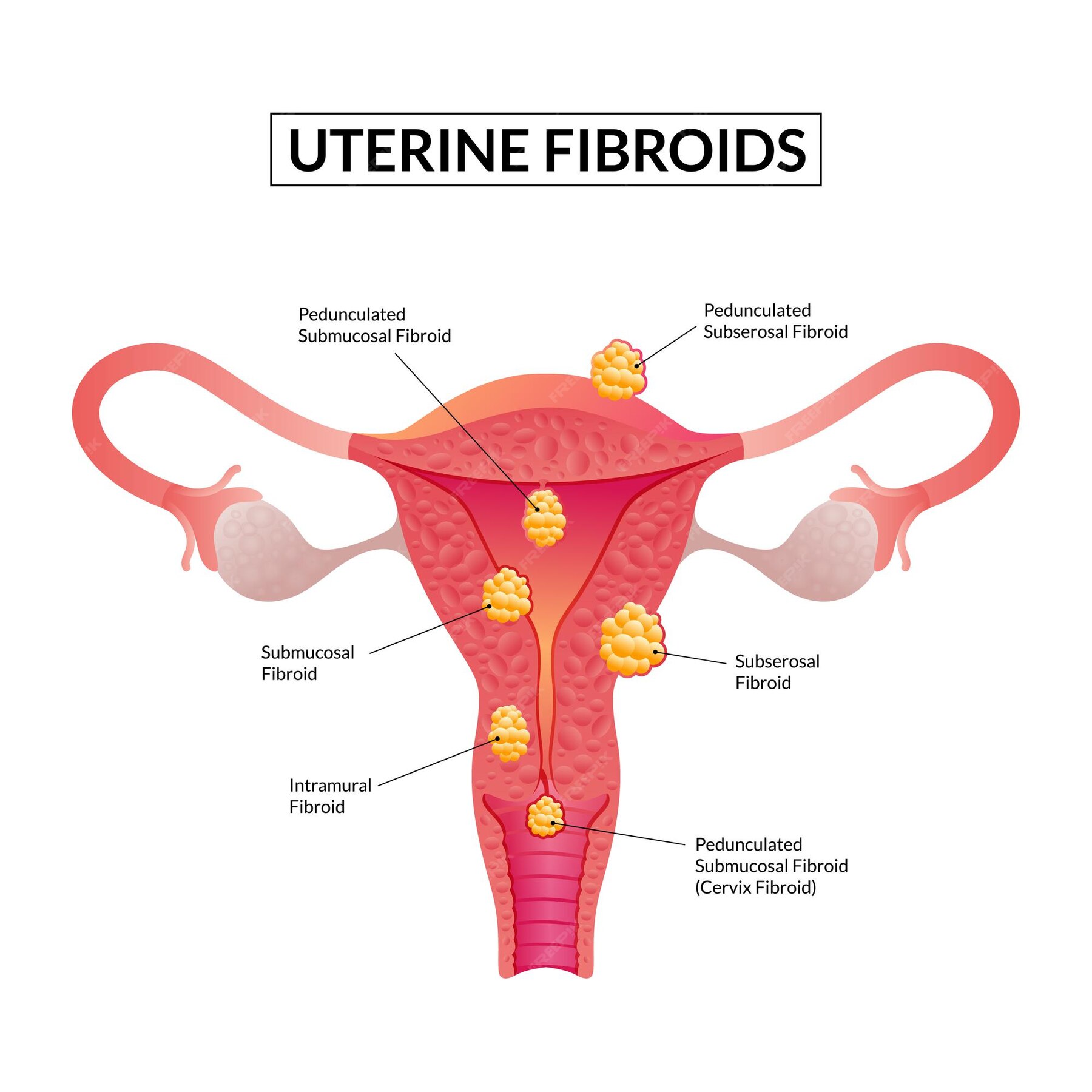 Premium Vector Types Of Uterine Fibroids Female Reproductive System